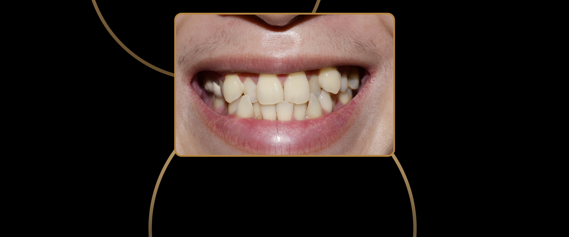 Invisalign For Crowded Teeth In Virginia Beach Lakeshore Dental